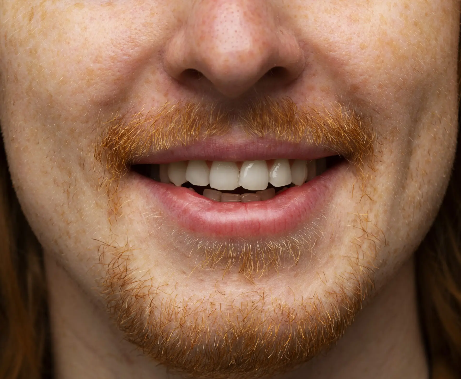 Overbite or Buck Teeth - Orthodontix